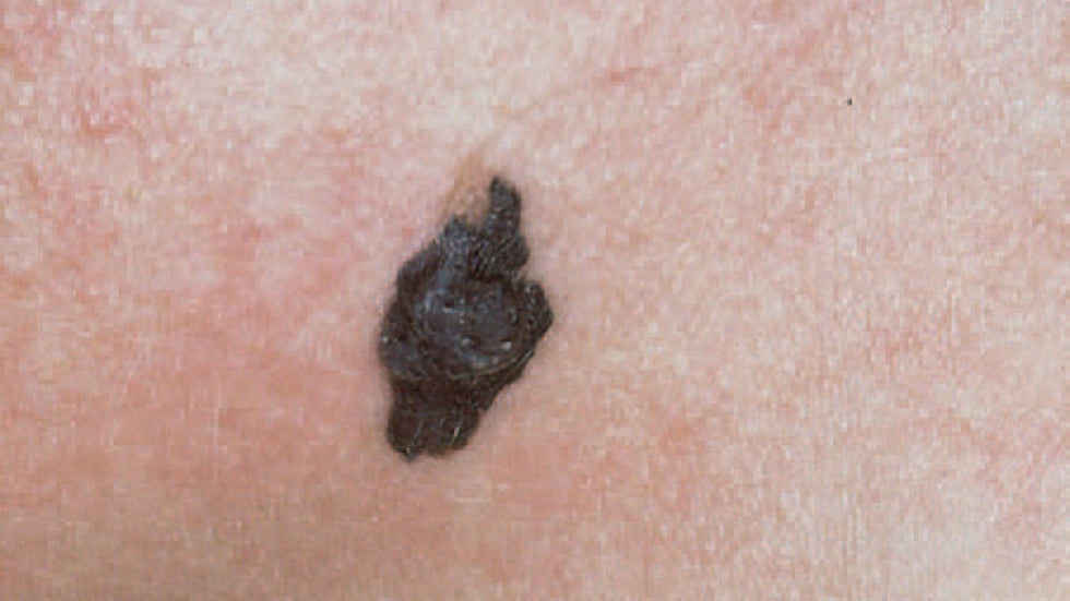 Identifying Skin Cancer: 37 Photos You Need to See | The Weather Channel
