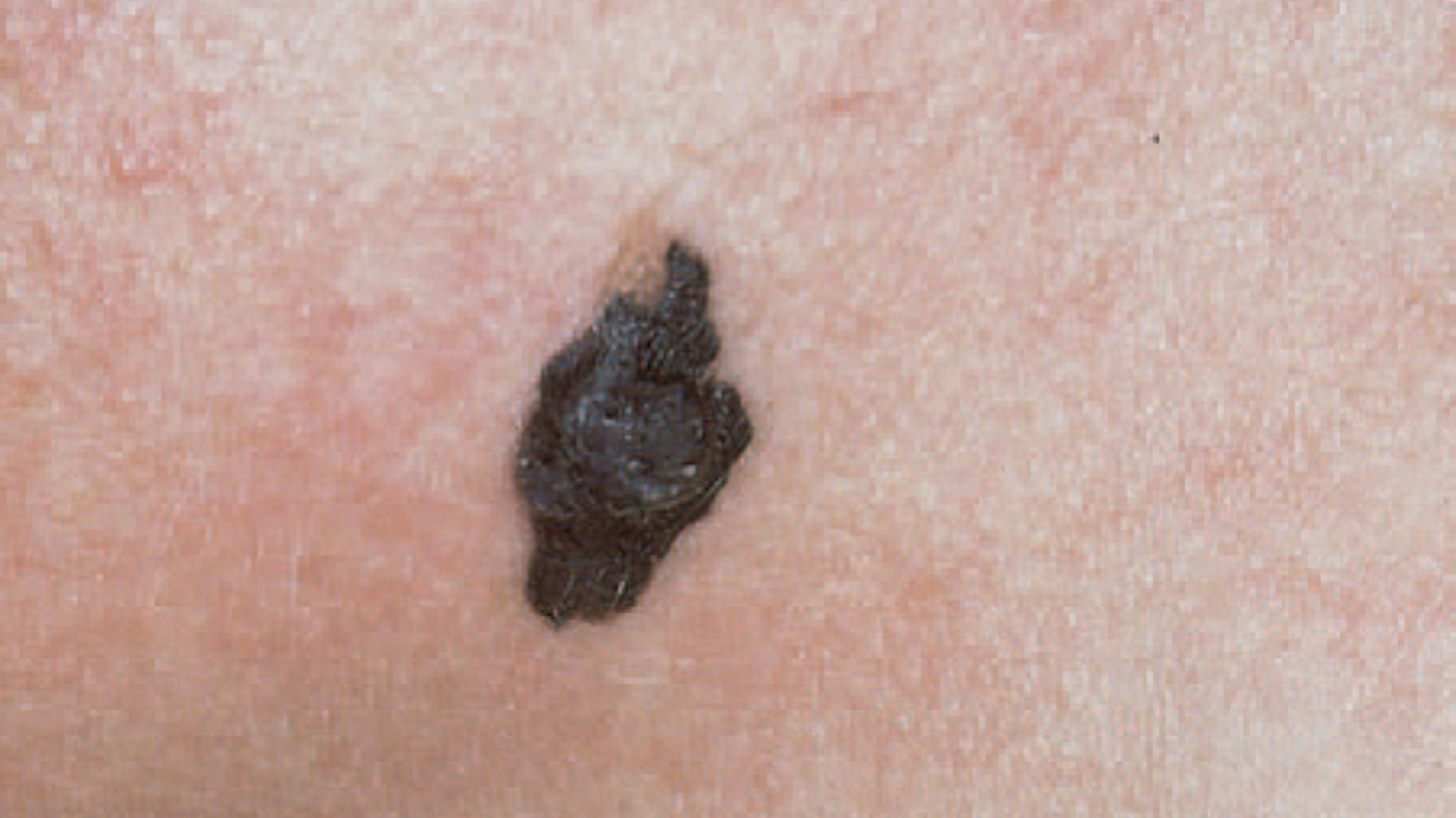 Identifying Skin Cancer: 37 Photos You Need to See | The Weather Channel