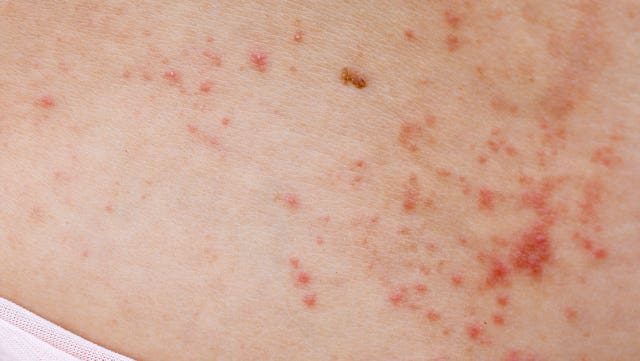 Is It Heat Rash Or Eczema? | Weather.com