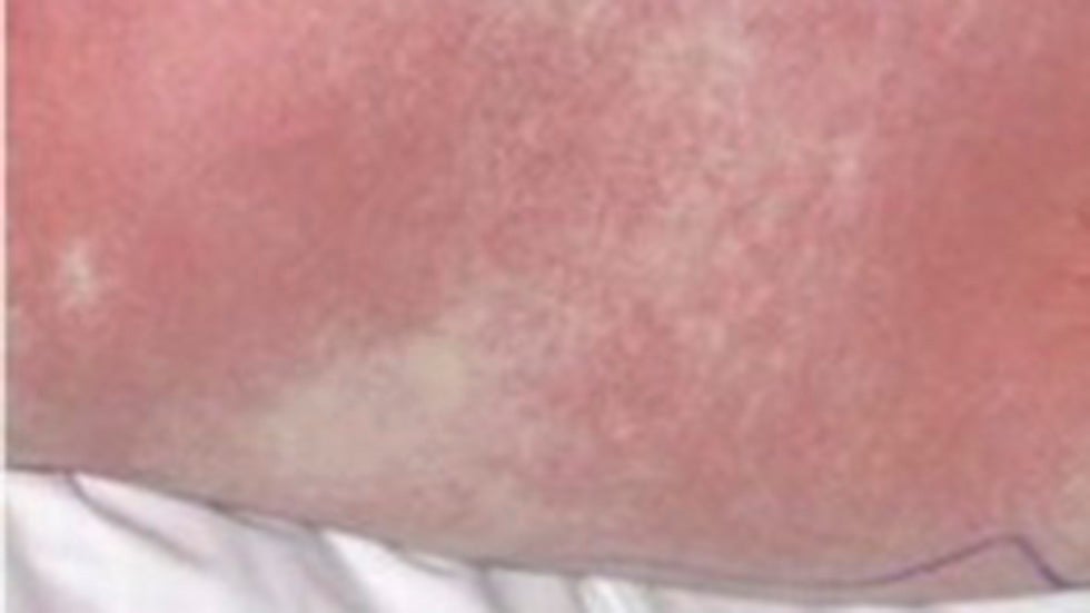 What Causes Baboon Syndrome? | The Weather Channel