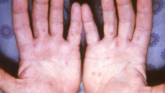 Chicken Pox Virus Chickenpox: What Is It? Why Is It Spreading At The